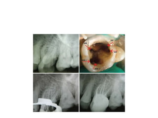 Magnification in endodontics | PPTX