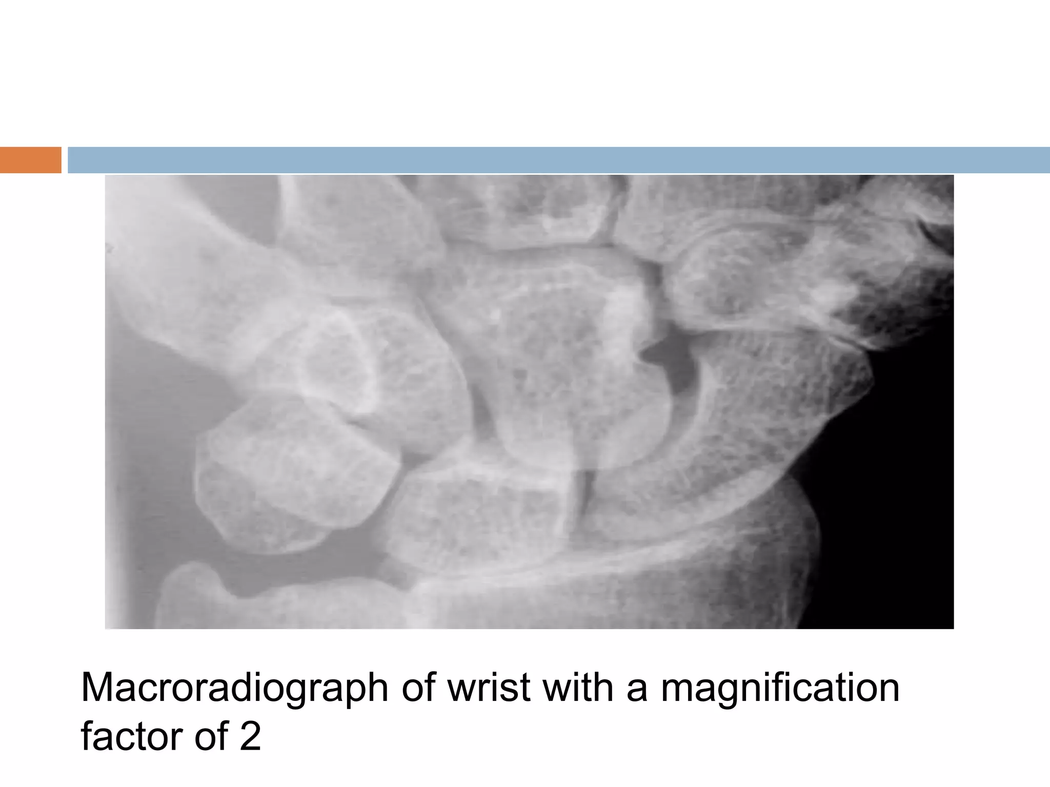 Magnification(macro and micro radiography), distortion | PPTX