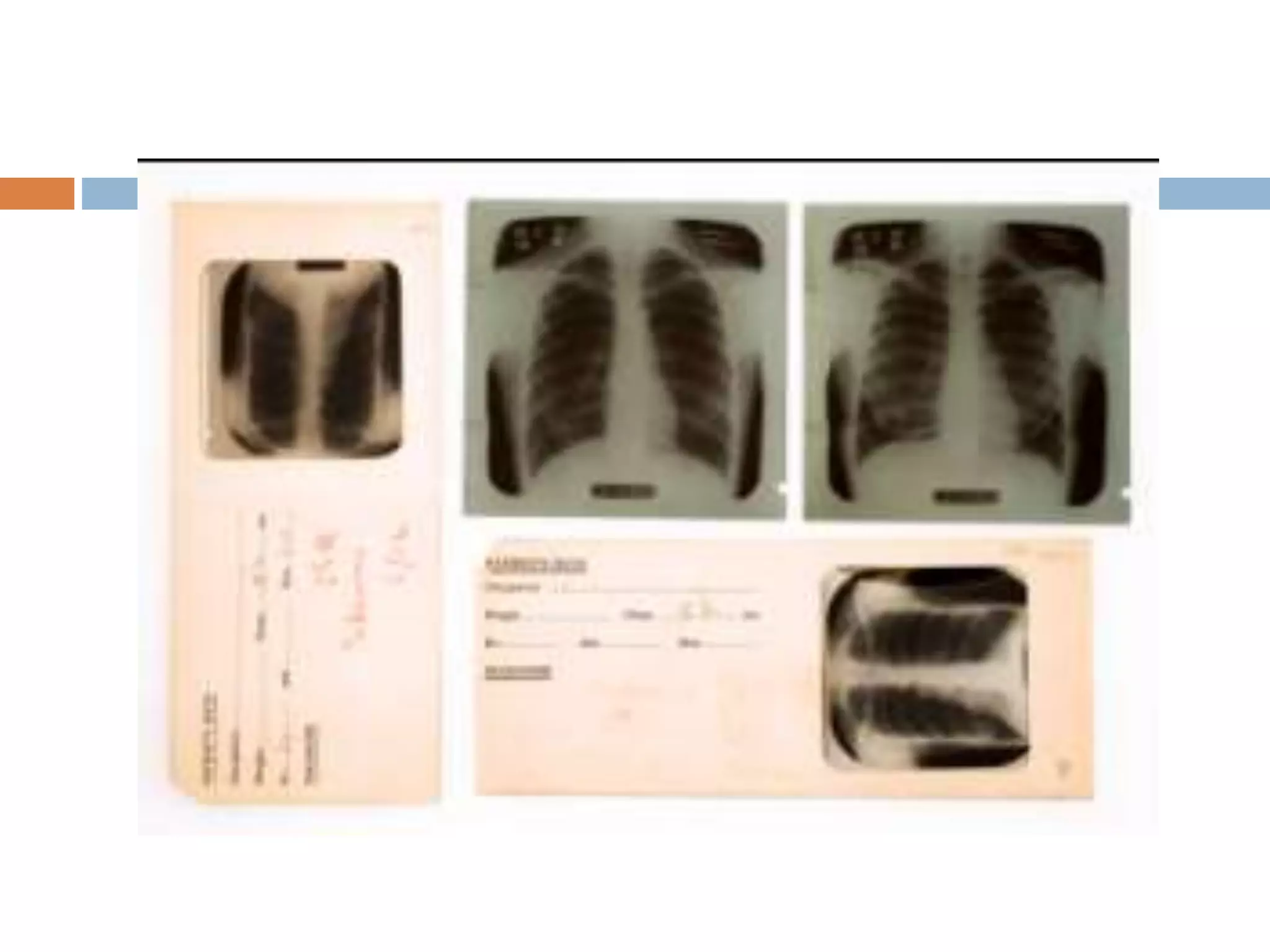 Magnification(macro and micro radiography), distortion | PPTX