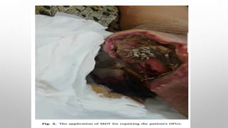 Maggots Therapy Parmeshwar Sahu Entomology.pptx