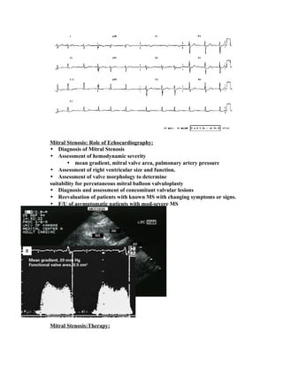 Valvular Heart Disease | PDF