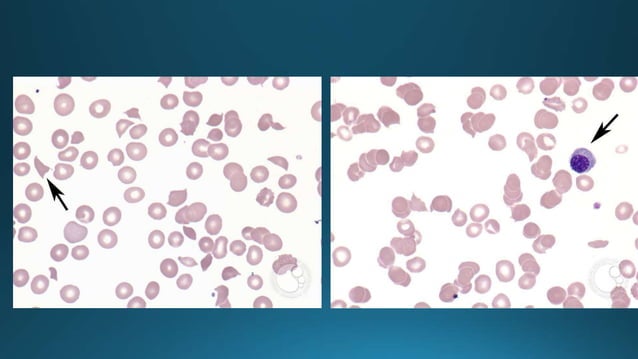 MICROANGIOPATHIC HEMOLYTIC ANEMIA | PPTX
