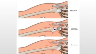 Shoulder Subluxation and shoulder dislocation.pptx