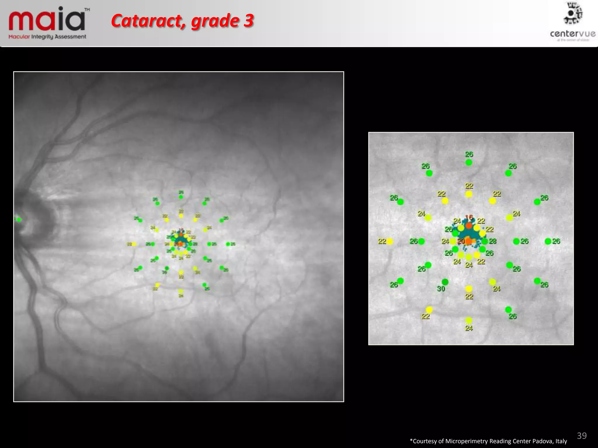 MAIA microperimetry centervue 100809 | PPTX