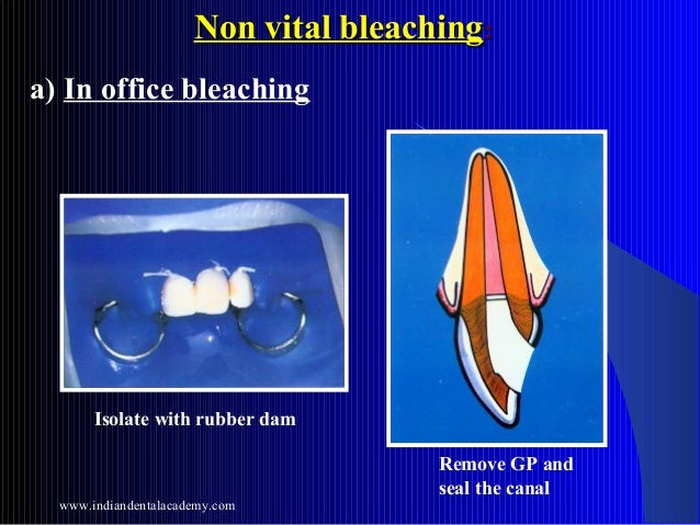 Main bleach/endodontic courses