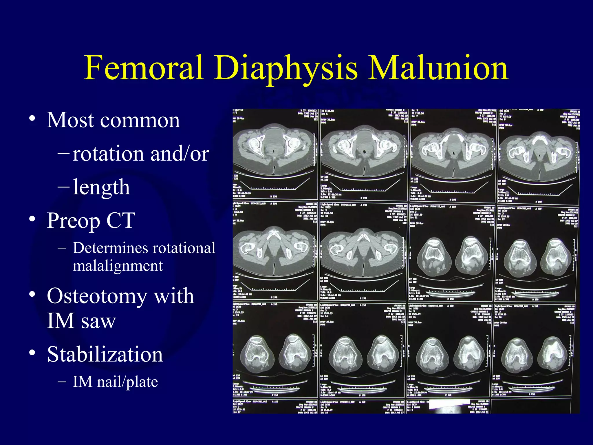 Malunion - Principals and Management - Dr Chintan N. Patel | PPT ...