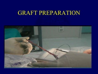 Graft choices for Anterior Cruciate Ligament - ACL Reconstruction - Dr ...
