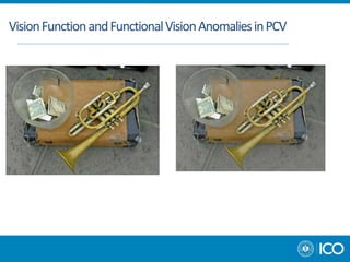 Diagnosis and Therapeutic Intervention of Vision Function and ...