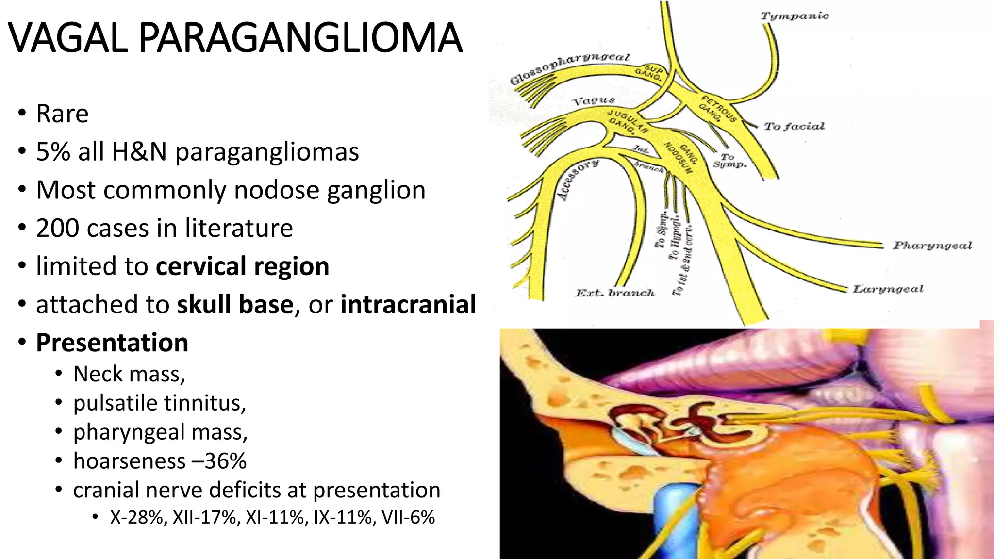 paragangliomas | PPTX