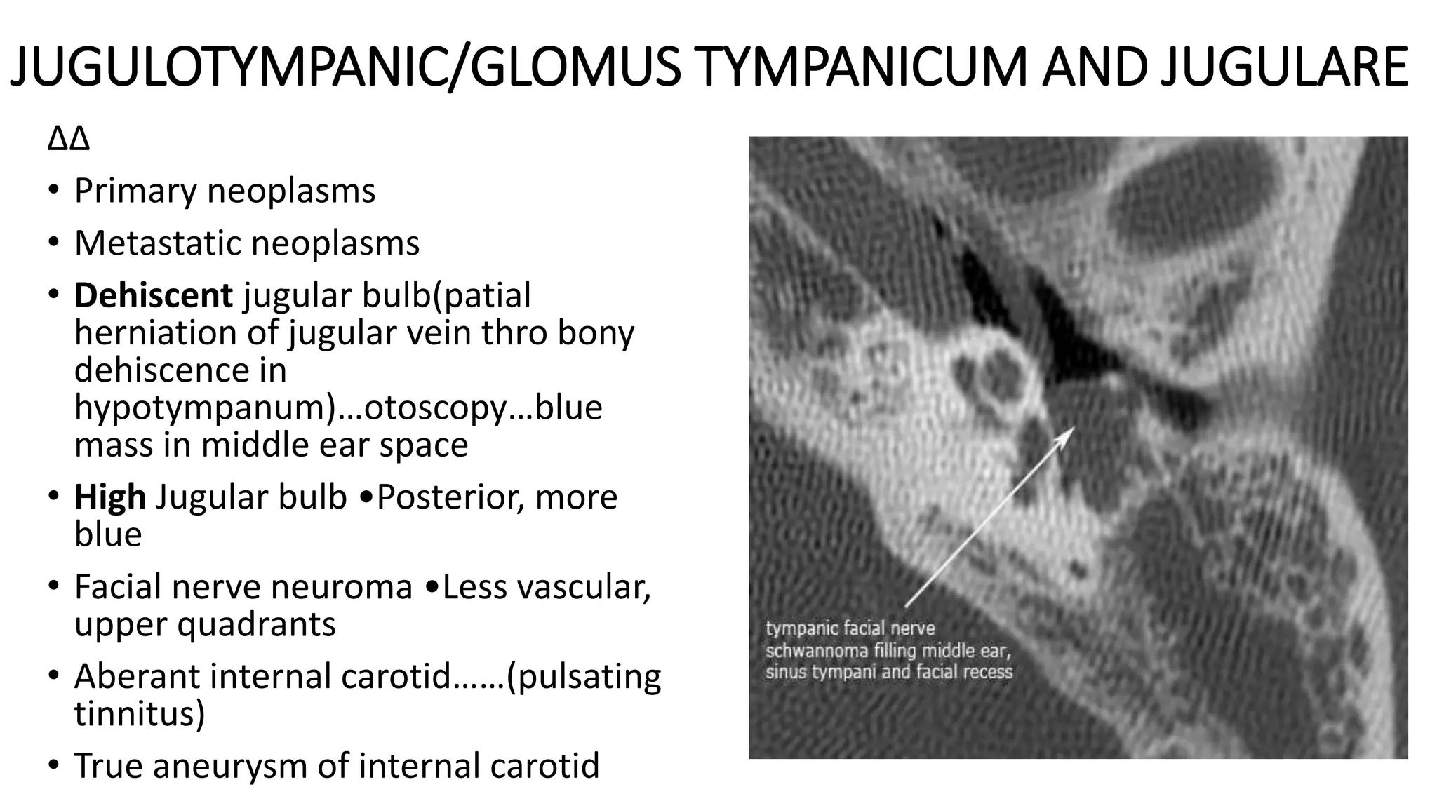 paragangliomas | PPTX