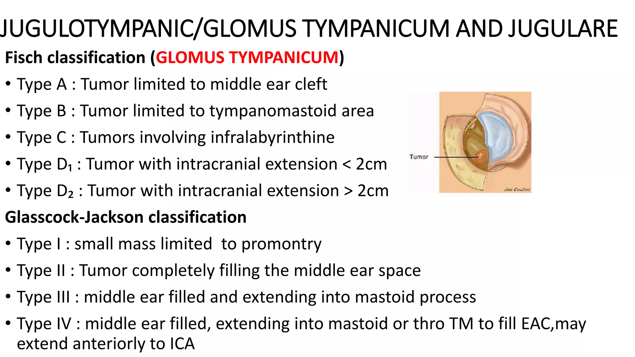 paragangliomas | PPTX