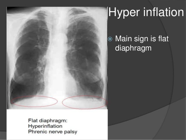 CXR imaging
