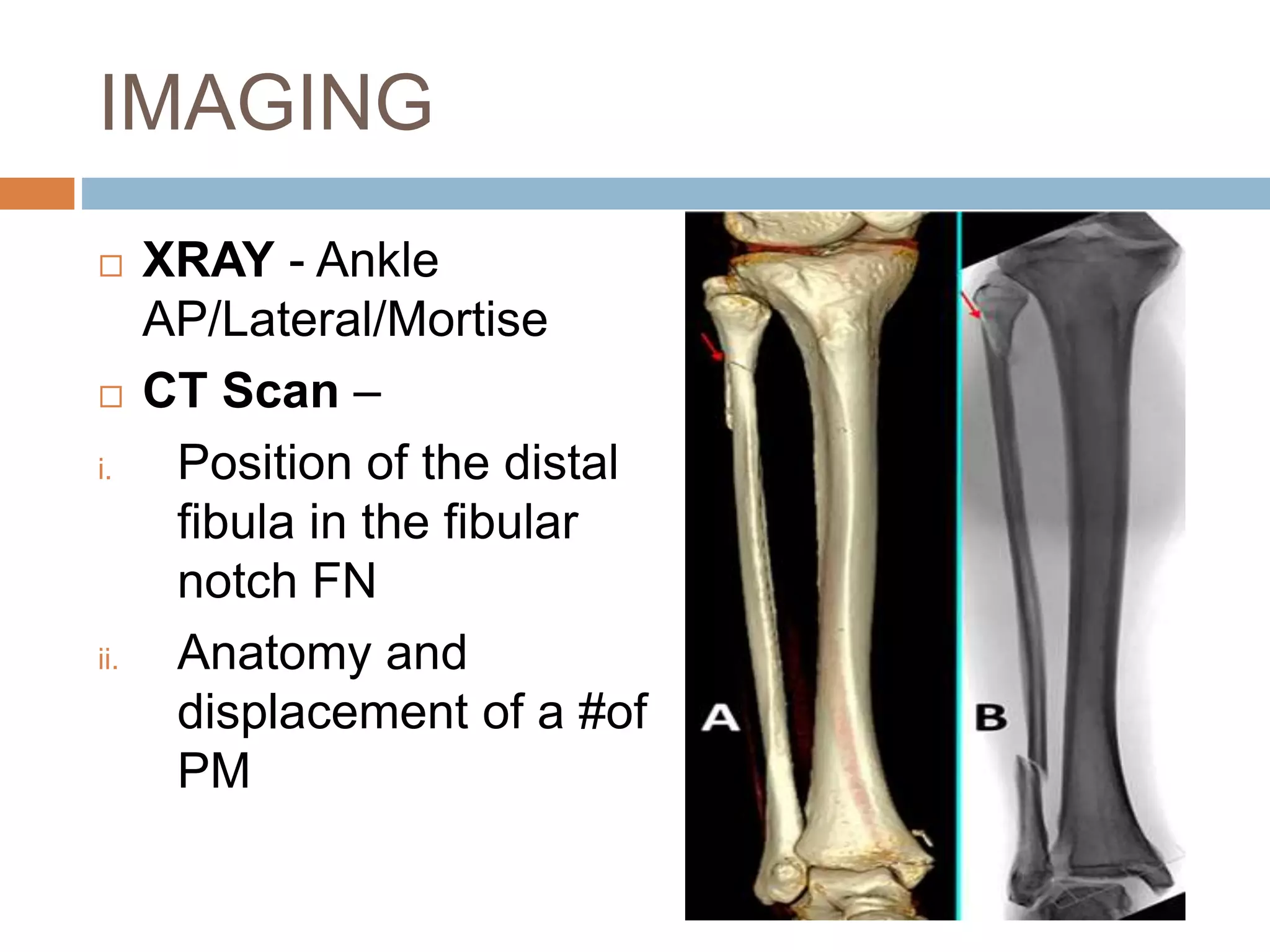 Maisonneuve fracture of ankle joint | PPTX