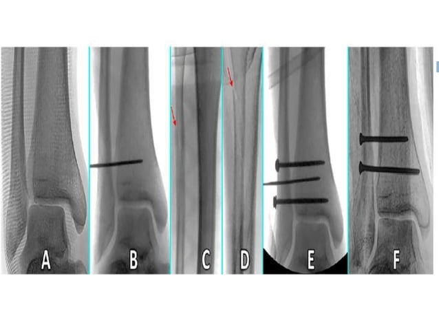 MAISONNEUVE FRACTURE OF ANKLE JOINT