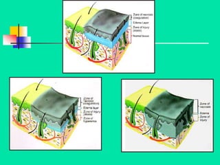 Major burn management | PPT