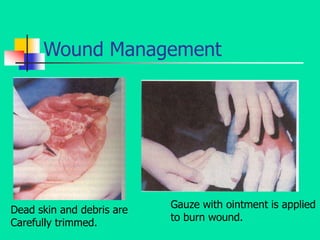 Major burn management | PPT