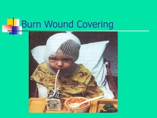 Major burn management | PPT