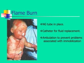 Major burn management | PPT