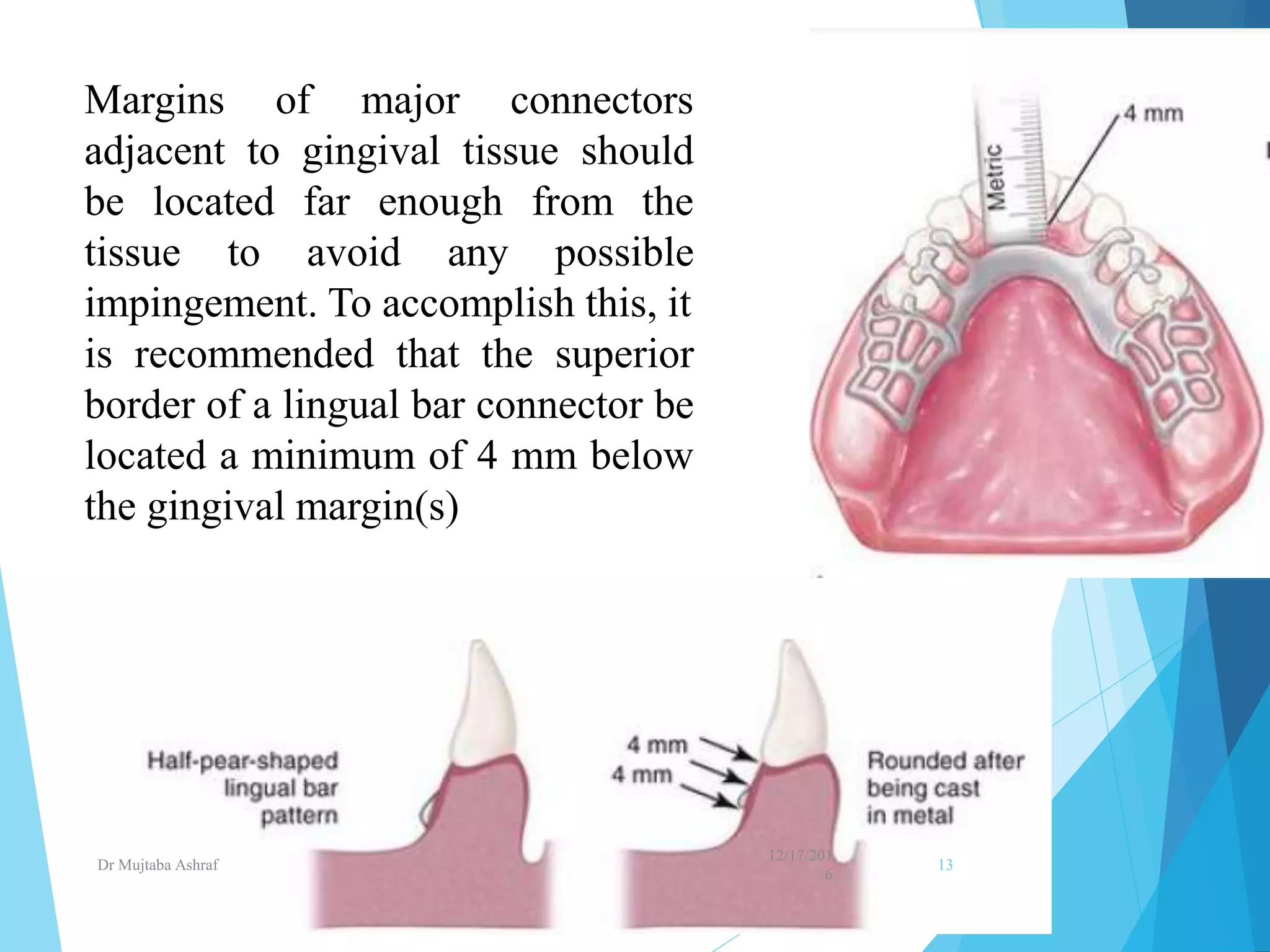 Major connector In prosthodontics | PPTX