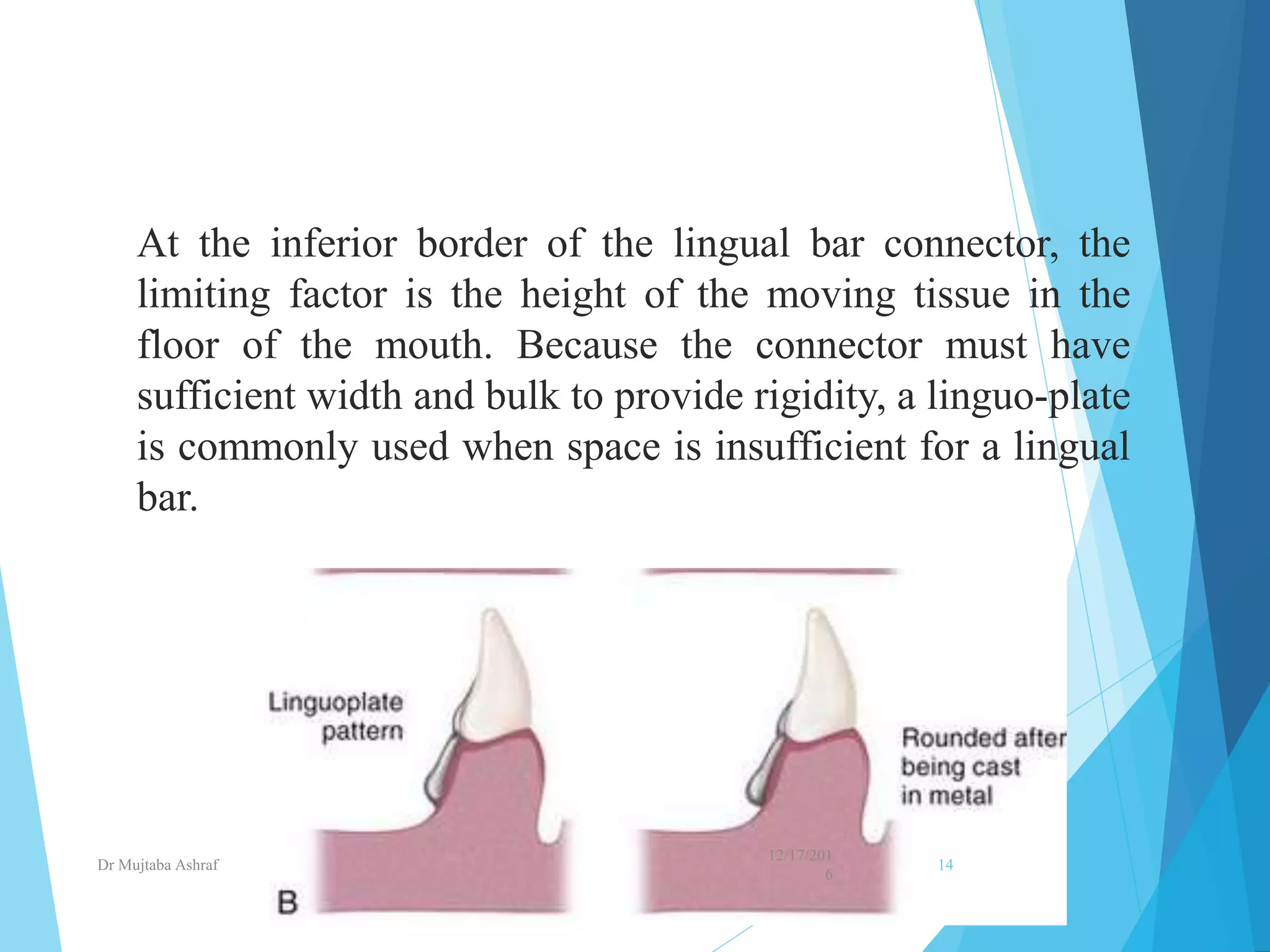 Major connector In prosthodontics | PPTX