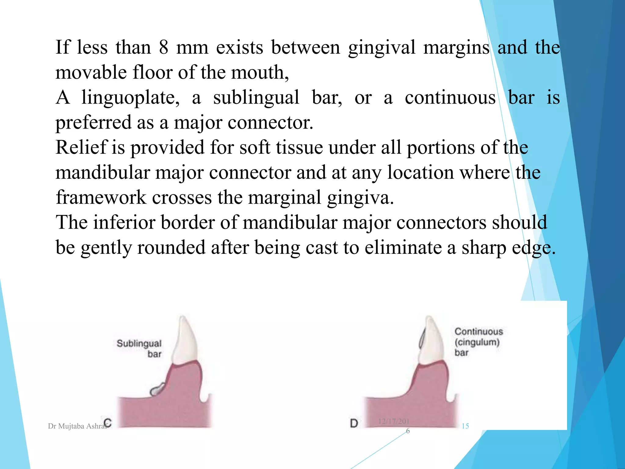 Major connector In prosthodontics | PPTX