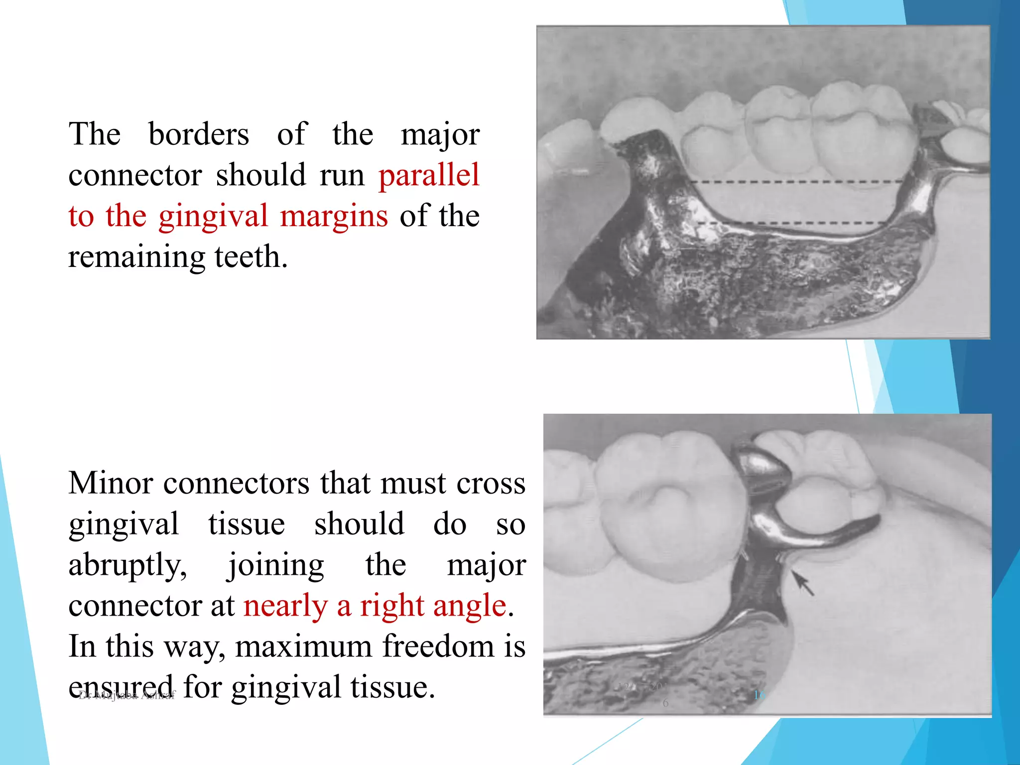 Major connector In prosthodontics | PPTX
