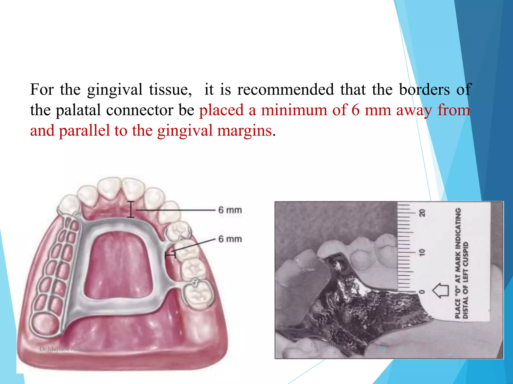 Major connector In prosthodontics | PPTX