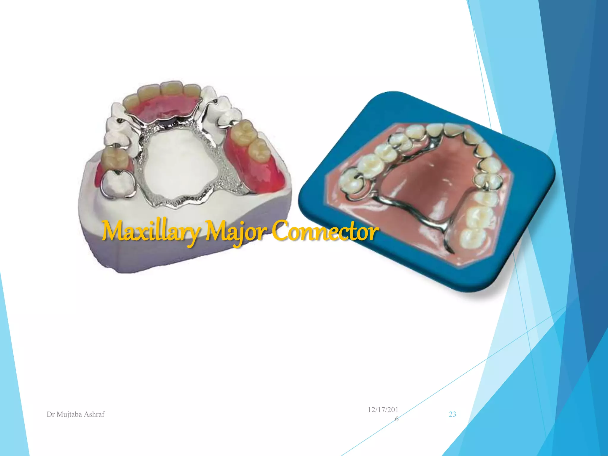Major connector In prosthodontics | PPTX
