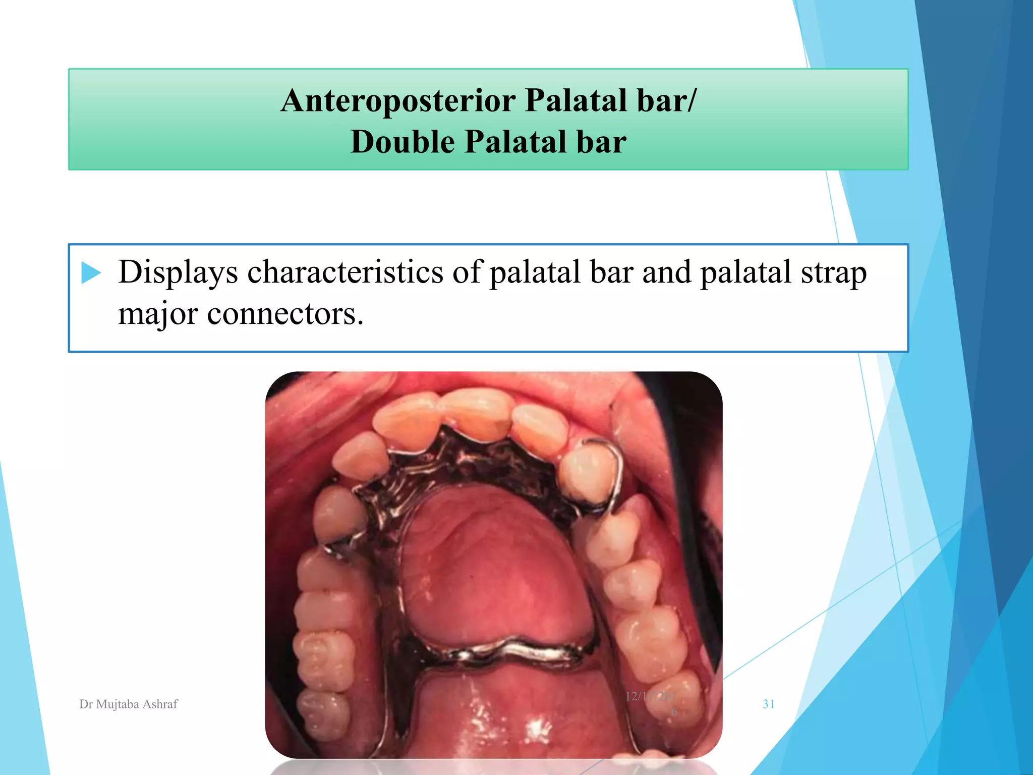 Major connector In prosthodontics | PPTX