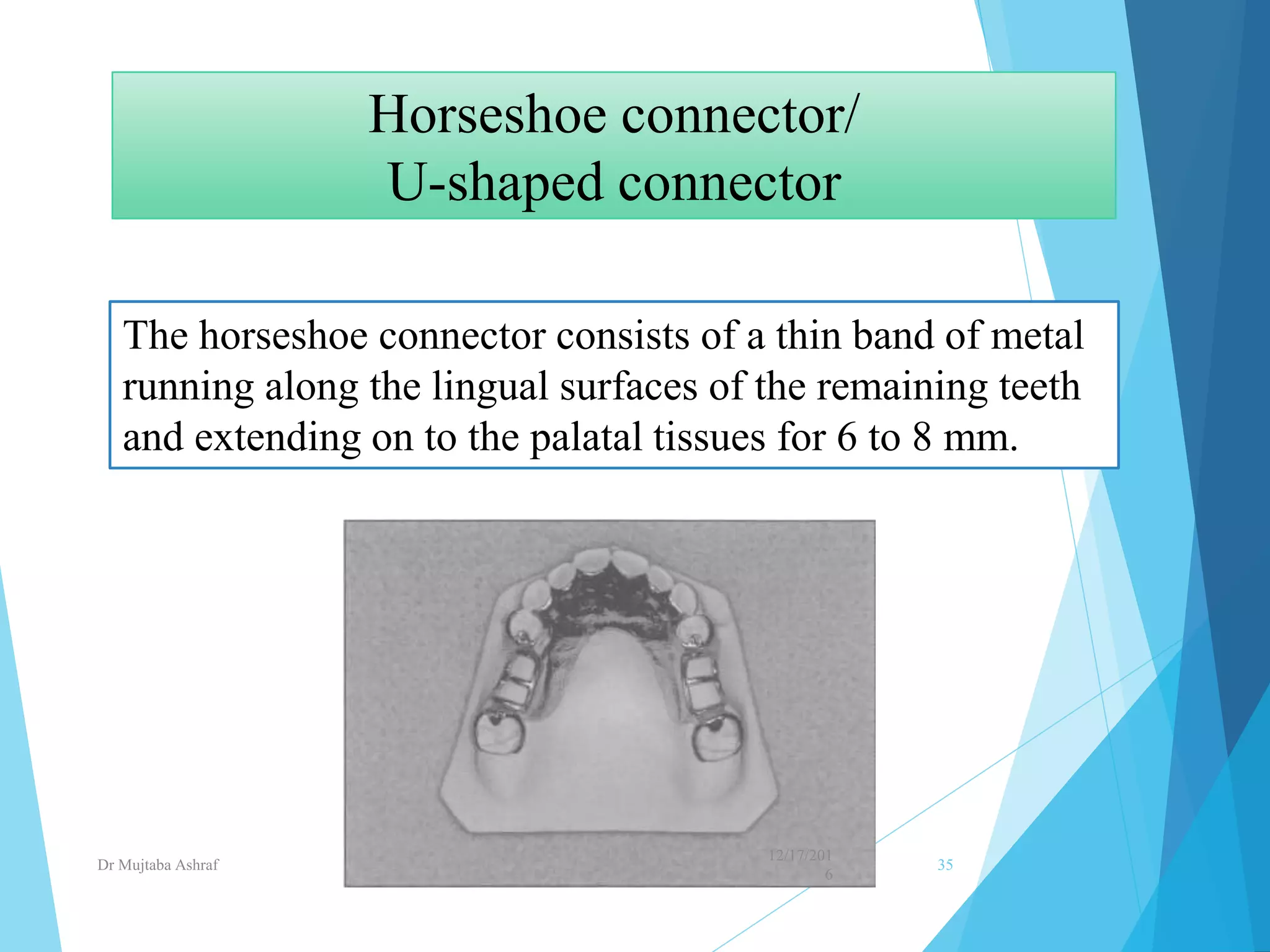 Major connector In prosthodontics | PPTX