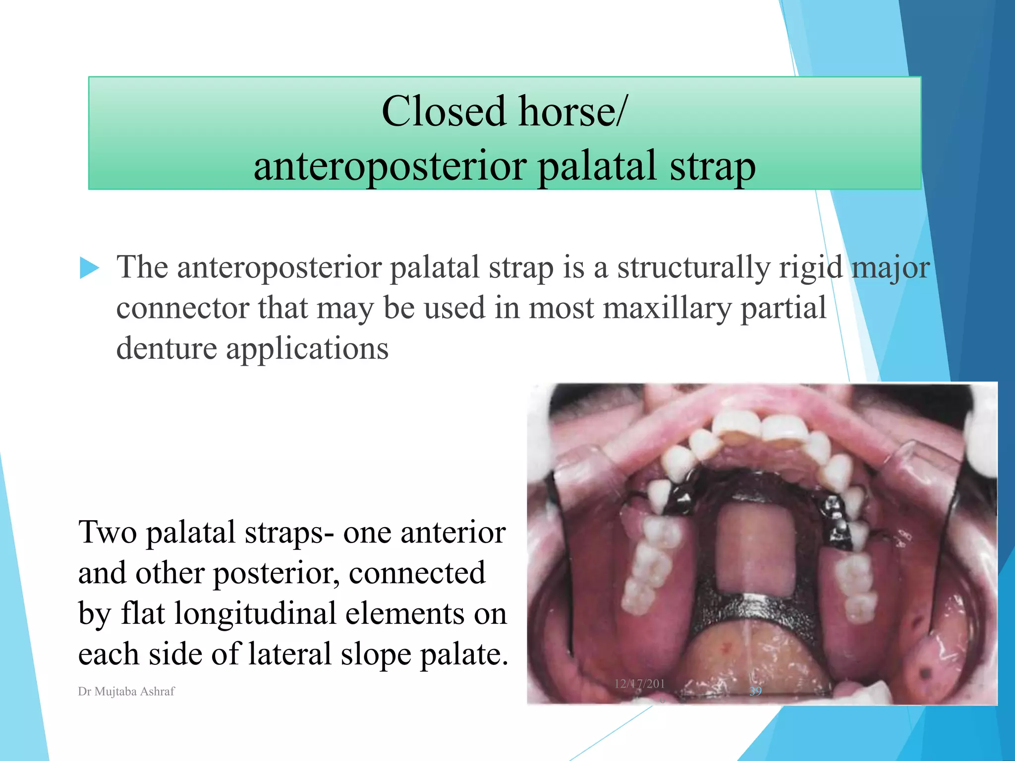 Major connector In prosthodontics | PPTX