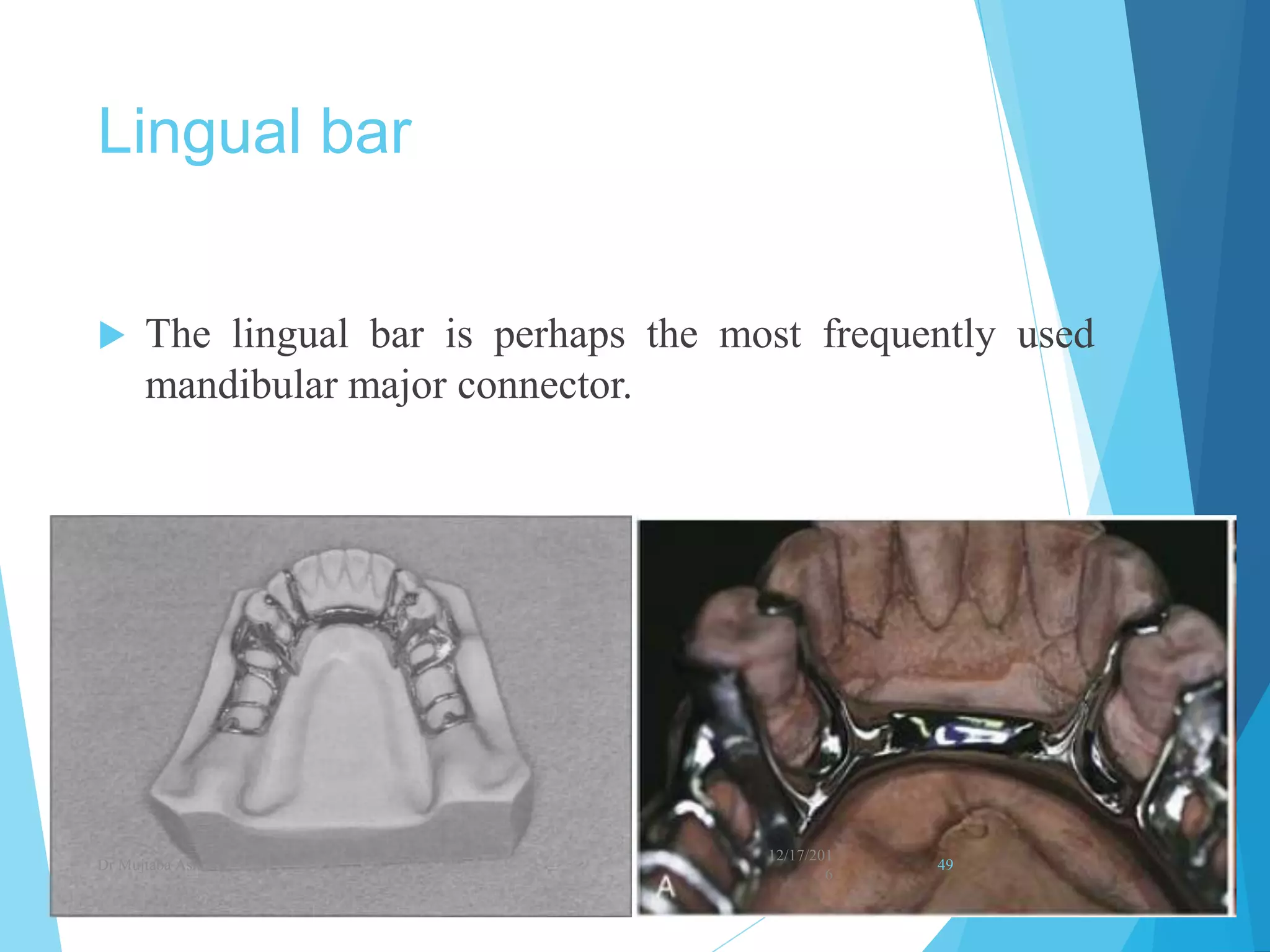 Major connector In prosthodontics | PPTX