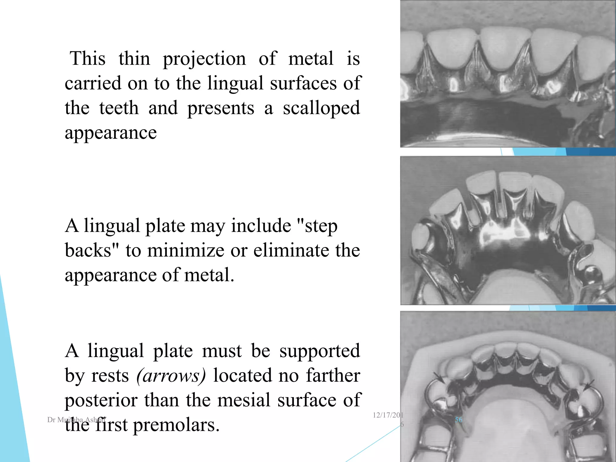 Major connector In prosthodontics | PPTX