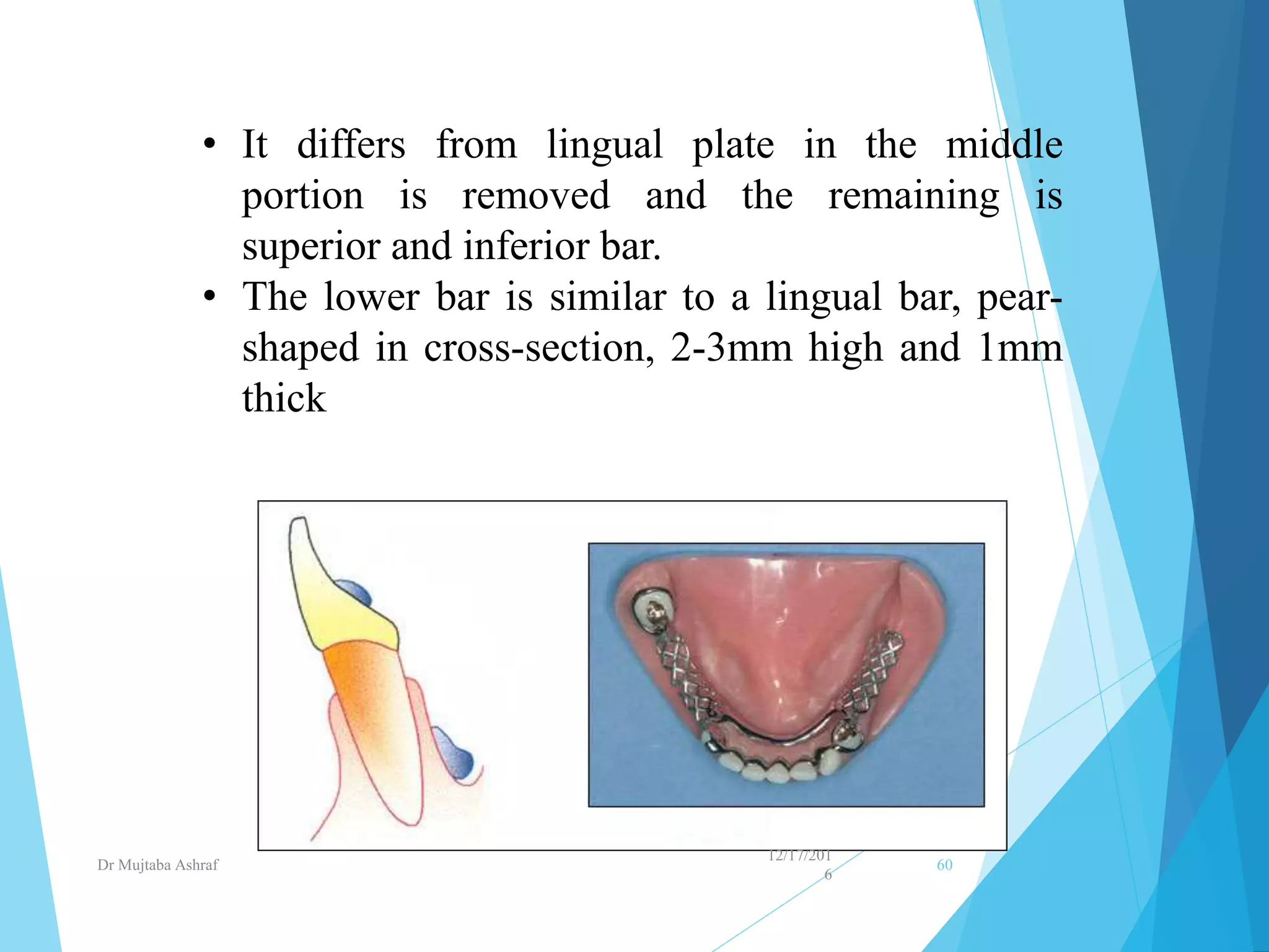 Major connector In prosthodontics | PPTX