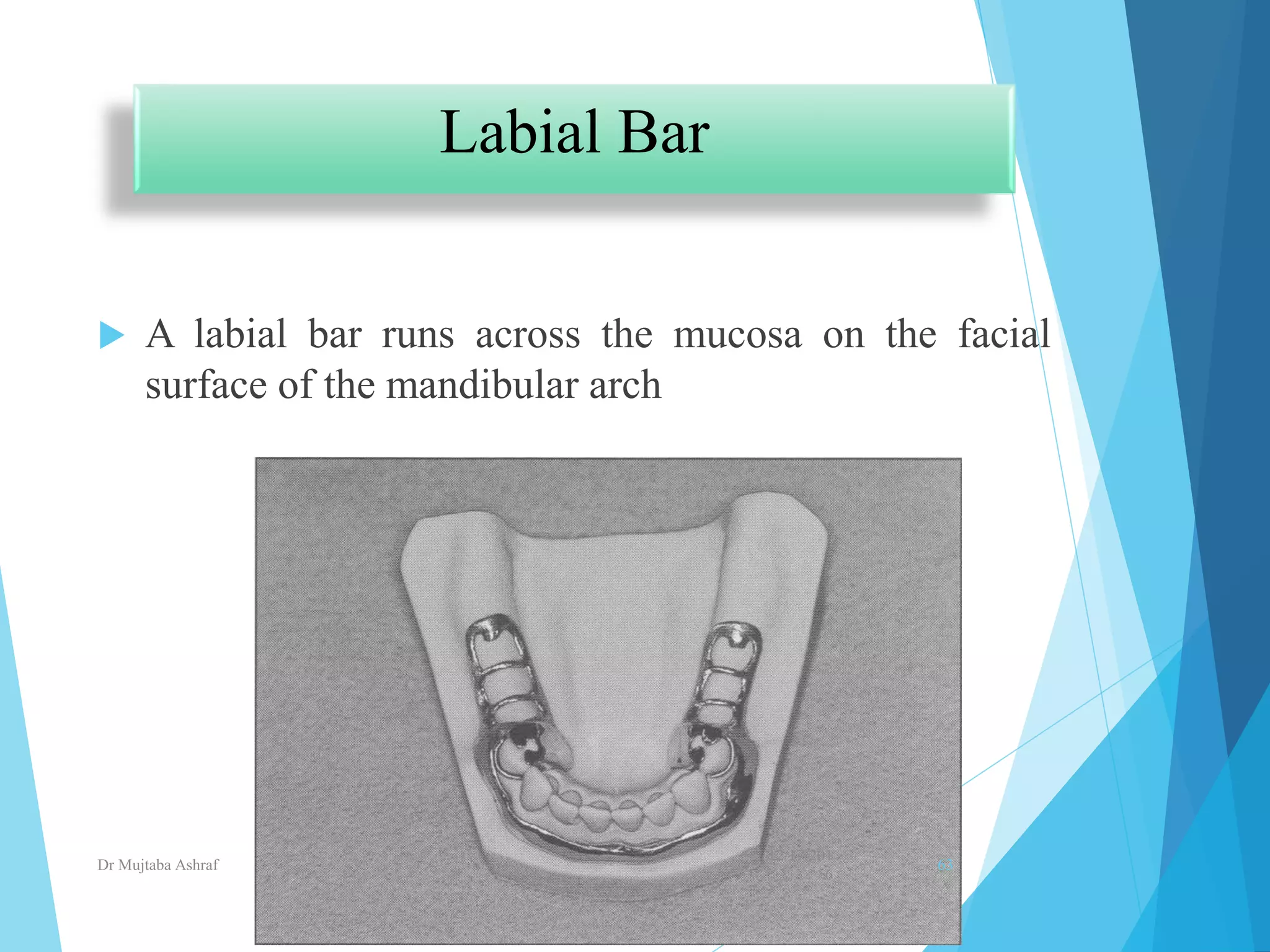 Major connector In prosthodontics | PPTX