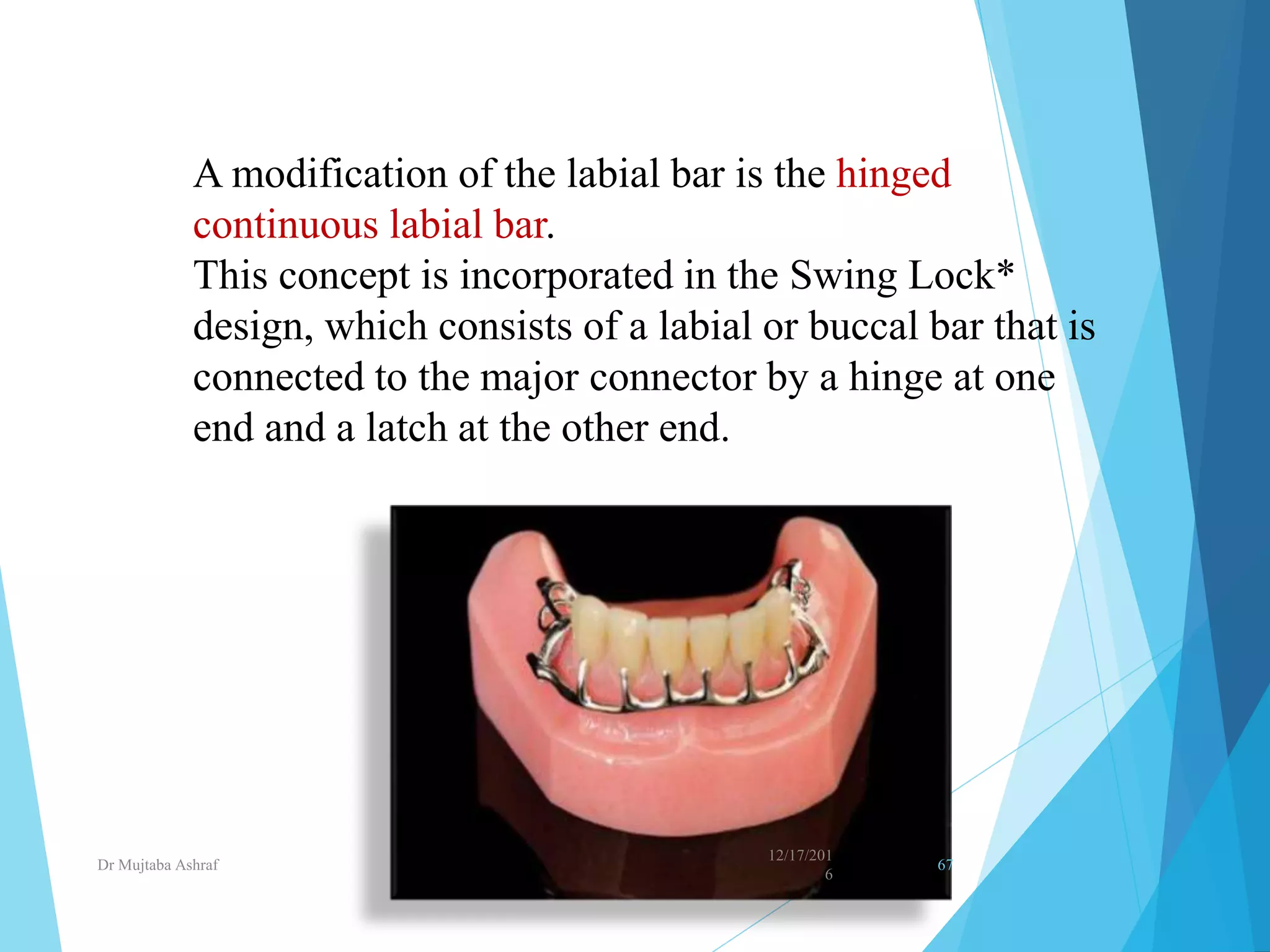 Major connector In prosthodontics | PPTX