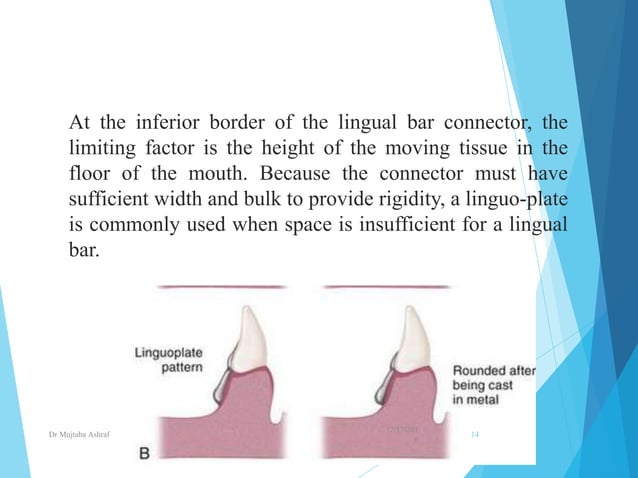 Major connector In prosthodontics | PPTX | Dental Health | Diseases and ...