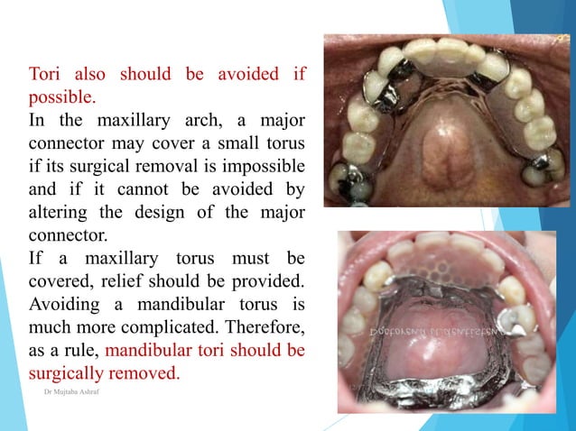 Major connector In prosthodontics | PPTX | Dental Health | Diseases and ...