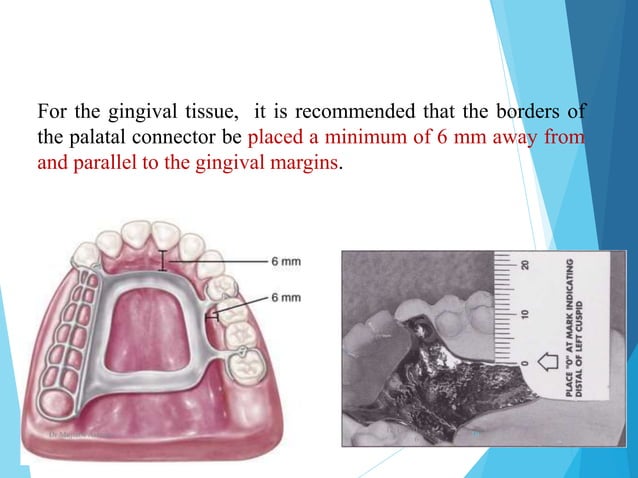 Major connector In prosthodontics | PPTX | Dental Health | Diseases and ...