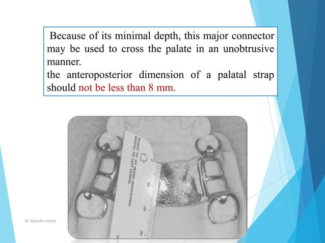 Major connector In prosthodontics | PPTX | Dental Health | Diseases and ...
