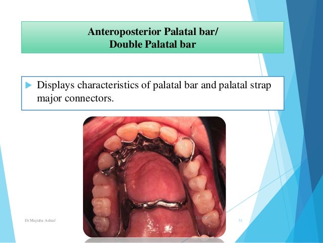 Major connector In prosthodontics