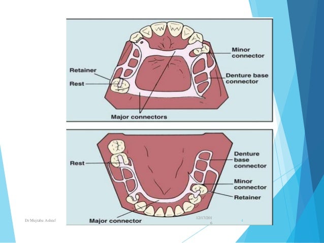 Major connector In prosthodontics