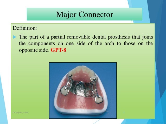 Major connector In prosthodontics