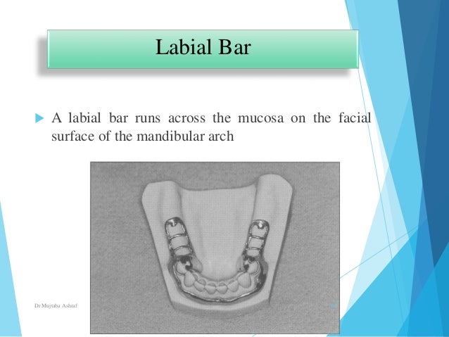 Major connector In prosthodontics
