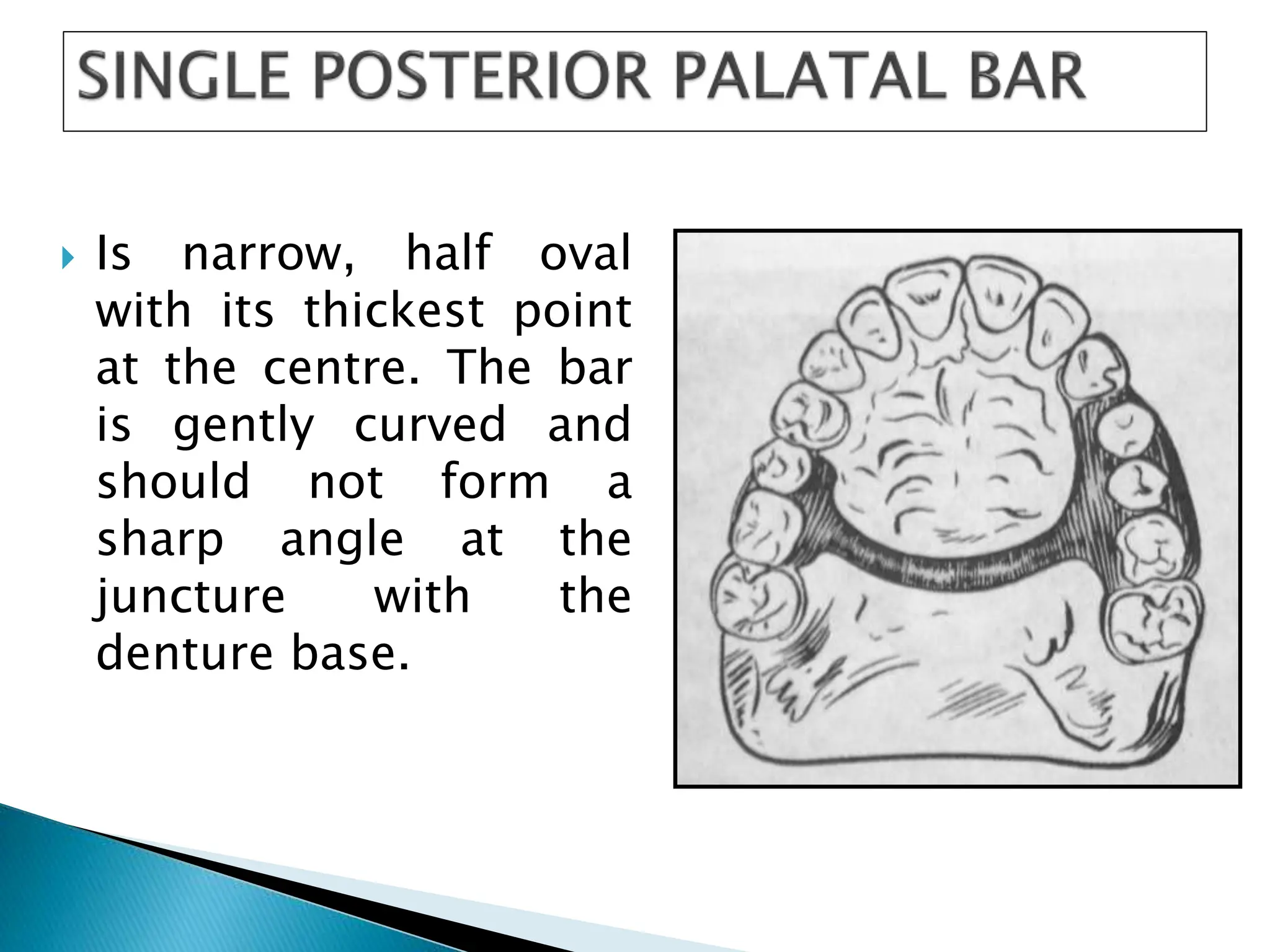 Major connector removable partial denture | PPTX