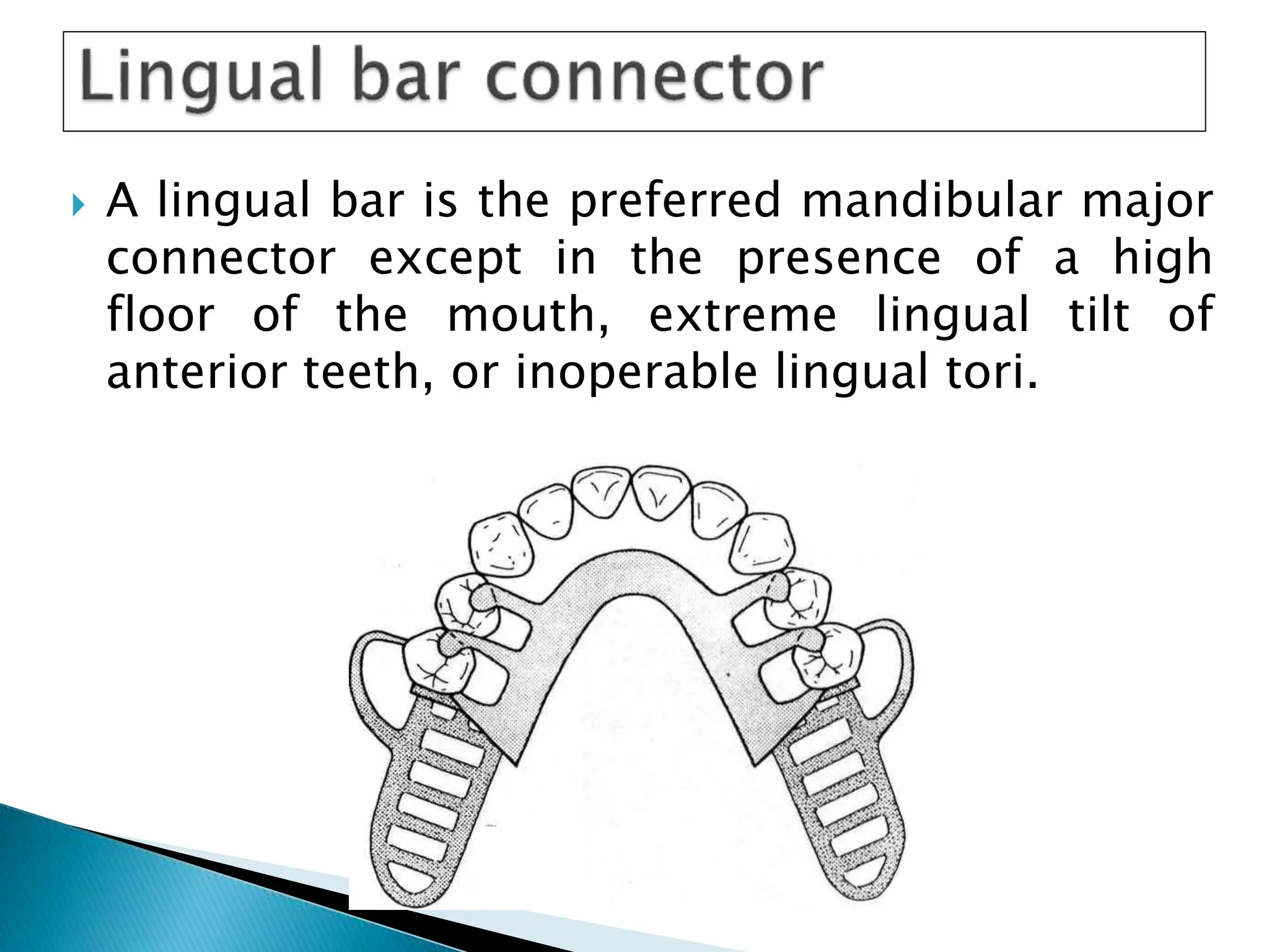 Major connector removable partial denture | PPTX