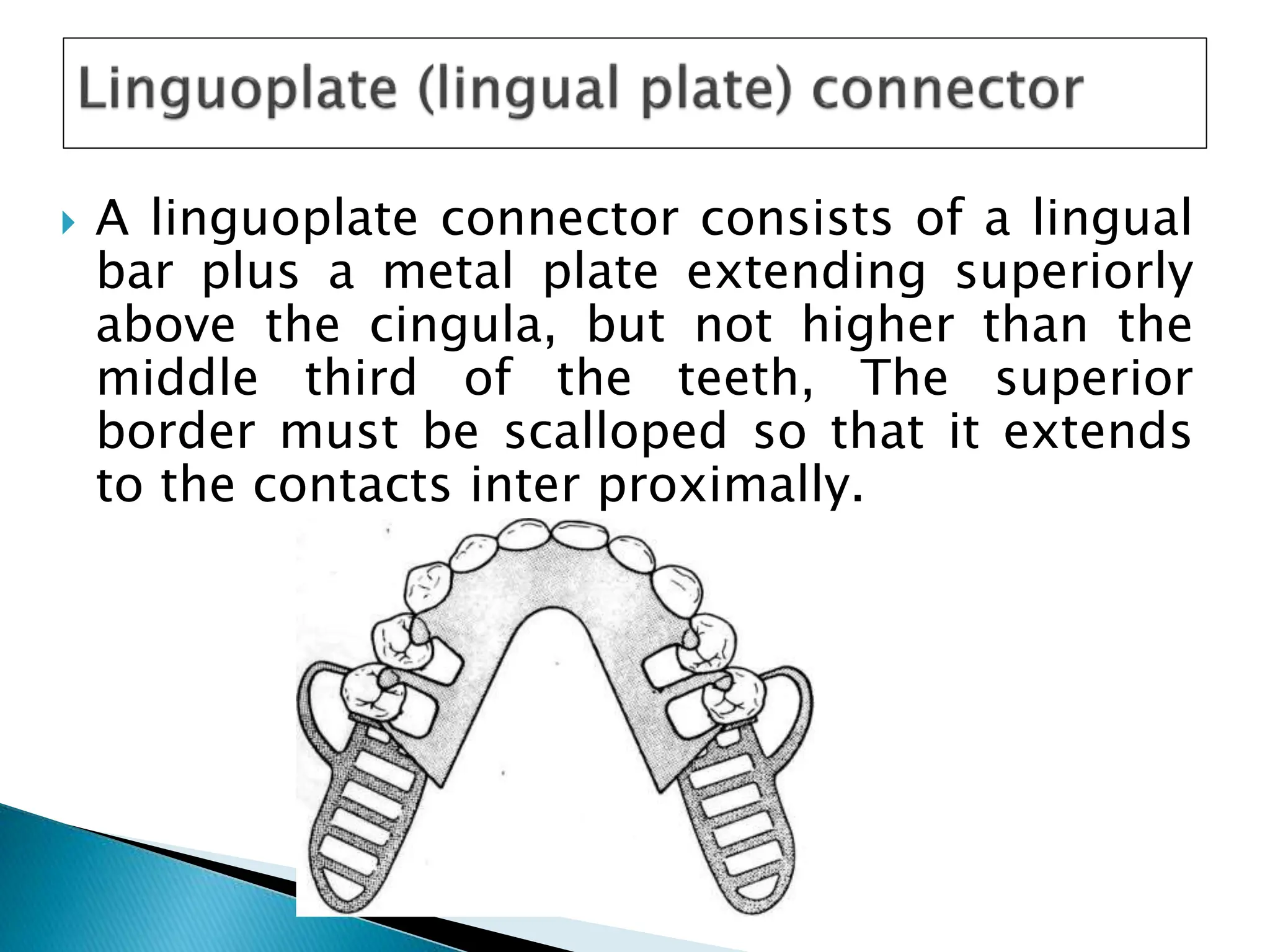 Major connector removable partial denture | PPTX