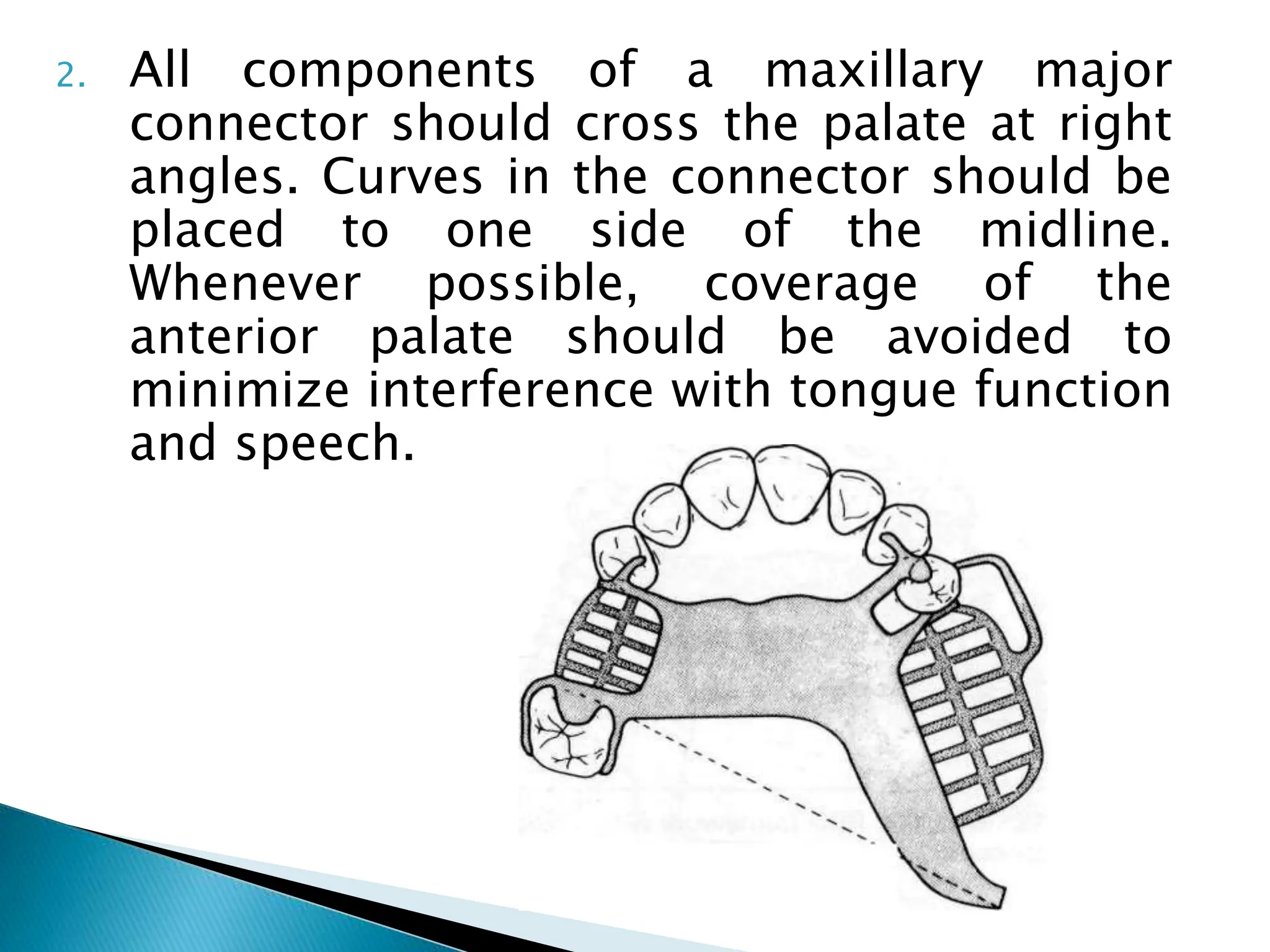 Major connector removable partial denture | PPTX