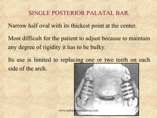 Major connectors/prosthodontic courses | PPT | Dental Health | Diseases ...