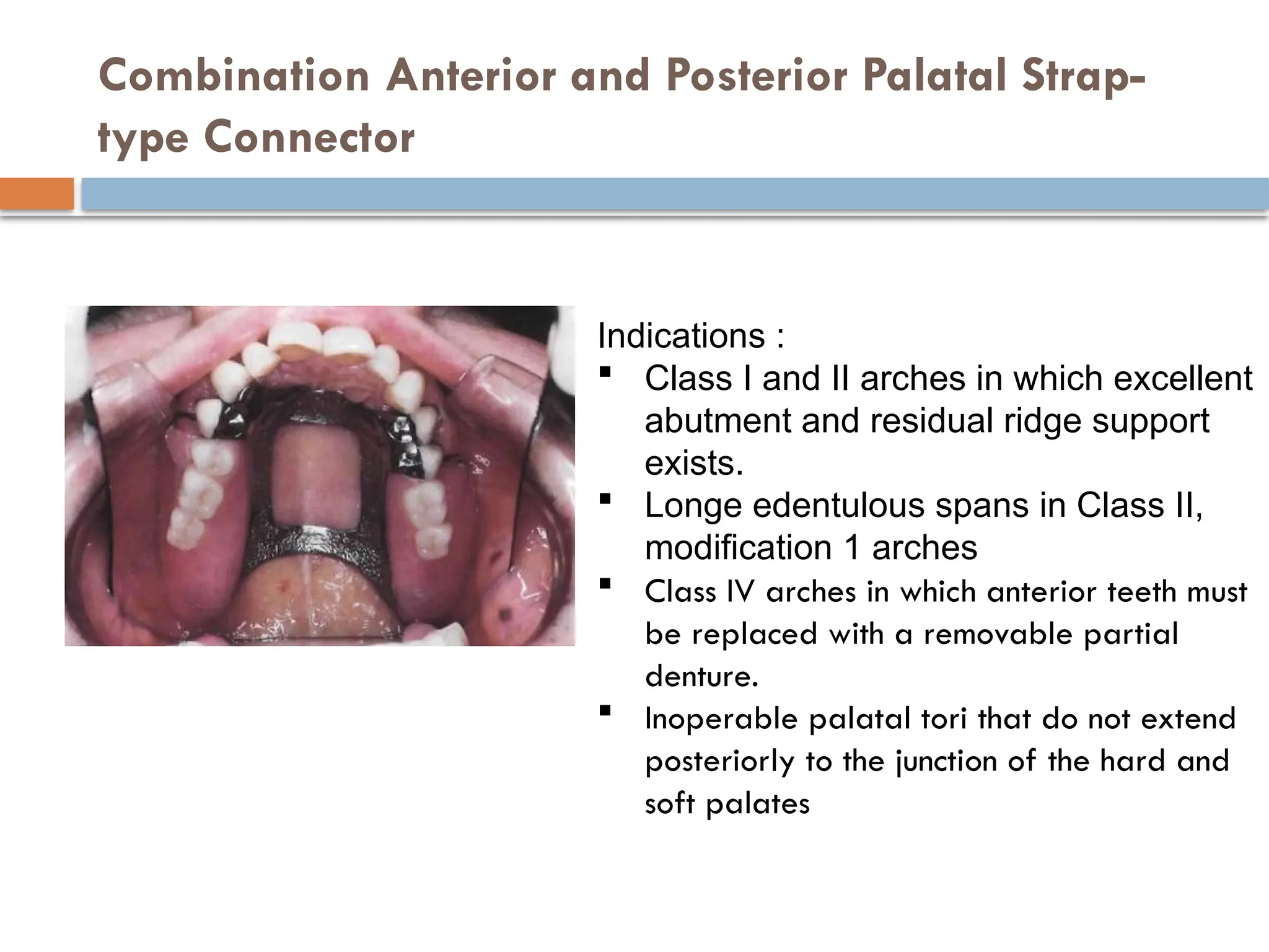 MAJOR connectors.pptx of removable partial denture | PPTX